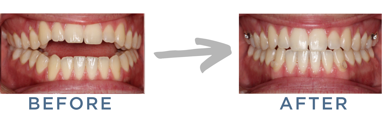 Even More Answers to All Your Questions About Invisalign - River Run Dental